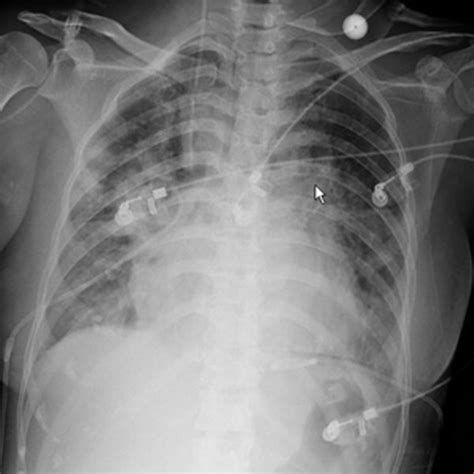 Chest X Ray Showing Diffuse Infiltrates Download Scientific Diagram