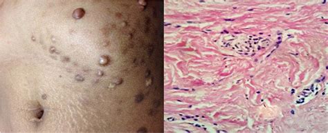 Nodular Keloidal Scleroderma Reumatología Clínica