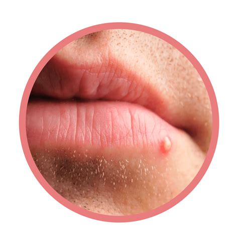 Dark Raised Spot On Lip