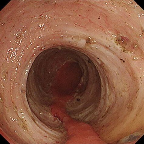 Circumferential Extent Of The Mucosal Defect After Endoscopic