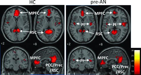 Default Mode Network Fc Maps In Hc And Pre An Spatial Maps Are Plotted Download Scientific