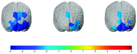 Significantly Decreased Neural Prefrontal Cortex Activation For The