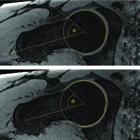 Alpha Angle Measurement For Bone A And Cartilage B Of The Hip Joint Download Scientific