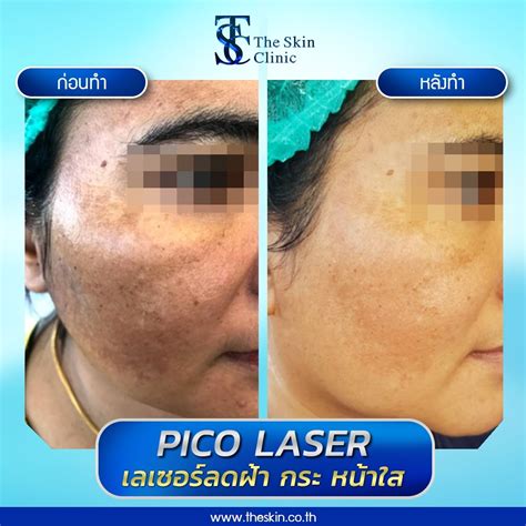Pico Laser รักษาฝ้า กระ