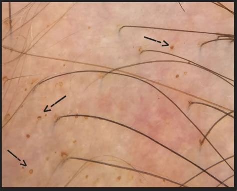 Trichoscopy Of Hair Dyes — Donovan Hair Clinic