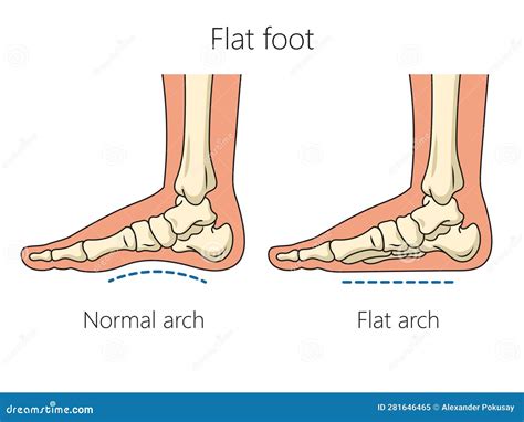 Flat Feet Bones Schematic Science Medical Image Stock Vector Illustration Of Neurology High