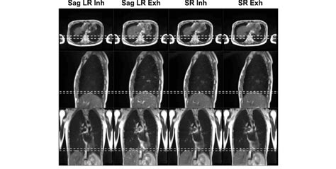 Comparison Of The Four Dimensional Super Resolution Sr Reconstruction Download Scientific