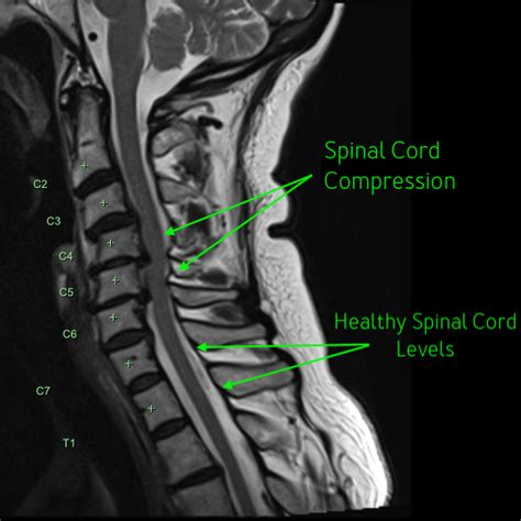 Cervical Myelopathy Prof Aaron Buckland
