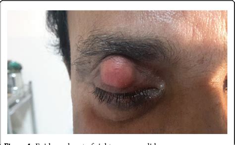 Figure 1 From Epidermal Cyst Of Upper Eyelid A Case Report With Literature Review Semantic