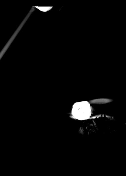 Chopart Fracture Radiopaedia 35347 36861 Sagittal Bone Window Nc Commons