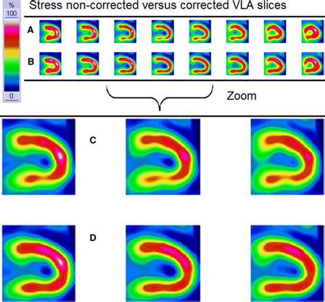 Applicability Of Data Driven Respiratory Motion Correction To Czt Spect Myocardial Perfusion