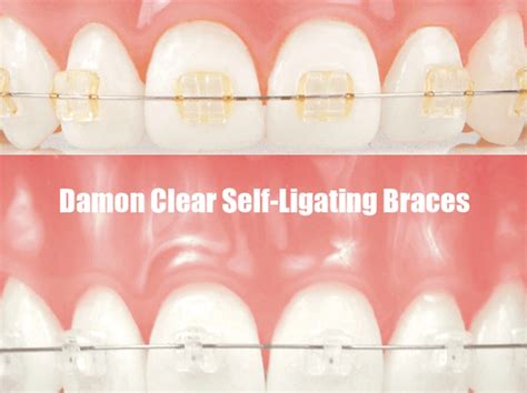 Conventional Braces Vs Self Ligating Braces An In Depth Guide