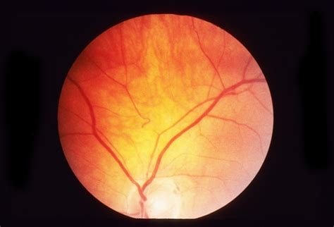 Multiple Retinal Arterial Macroaneurysms Retina Image Bank