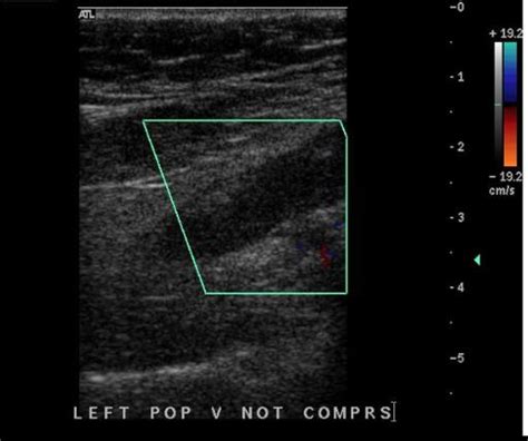 Thromboembolism Pe And Dvt Prophylaxis Basic Science Orthobullets