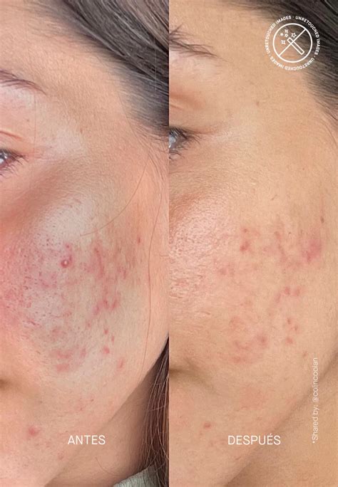 Theramid Azid 15 Acid Azelaik 30ml Oskin 2025