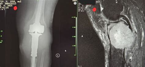 Proximal Tibia Replacement Is An Operation With A Higher Percentage Of David Musil