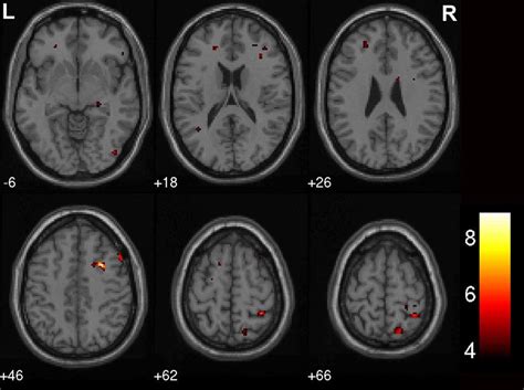 Spatial Parametric Bold Activation Maps For Mr Condition Contrast