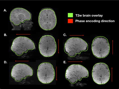 Susceptibility Induced Magnetic Field Inhomogeneity Causing Geometric Download Scientific