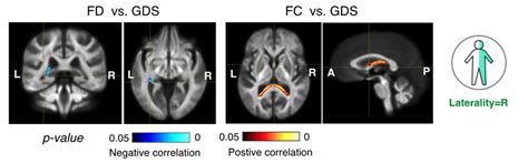 Correlation Between Fixel Based Metrics And Clinical Evaluations In Download Scientific Diagram