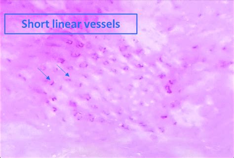 dermoscopy of classic patch mf showing short linear vessels