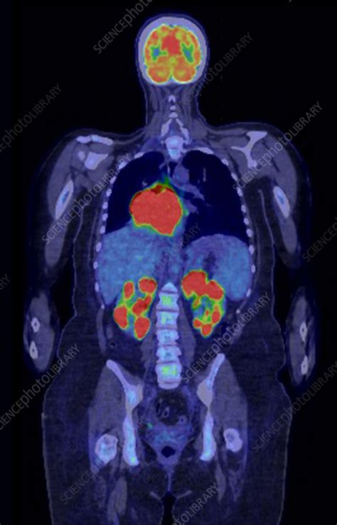 Diffuse Large B Cell Lymphoma CT And PET Scan Stock Image C Science Photo Library