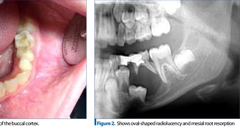 Dentigerous Cyst Marsupialization