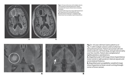 Neuroradiology Tumefactive Demyelination Pptx