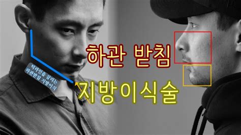 턱 짧은 남자 연예인 턱 라인 엣지를 살리는 하관받침 지방이식술 Youtube