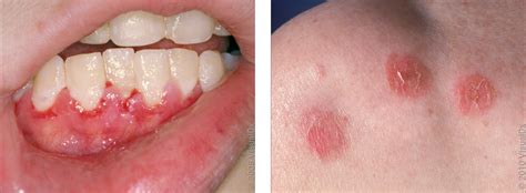 Autoimmune Rashes Causes Treatments And Pictures Goodrx