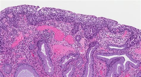 High Grade Squamous Intraepithelial Lesion Of The Cervix Ottawa Atlas Of Pathology