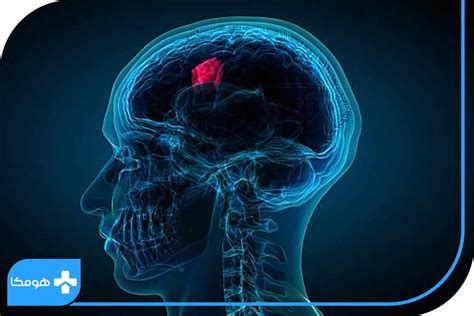 تومور مغز و دانستنی‌های آن ایا تومور مغزی کشنده است؟ مجله هومکا