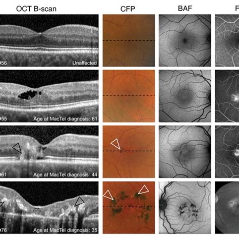Donor Ipsc Derived Rpe Cells Are Functional Rpe Cells A Download Scientific Diagram