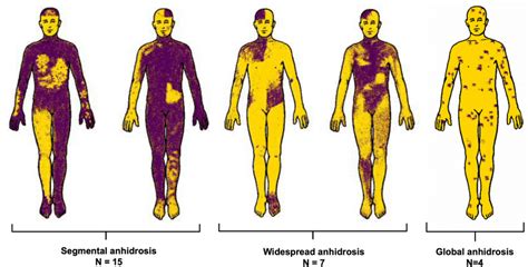 The Different Distributions Of Sudomotor Involvement On Download Scientific Diagram