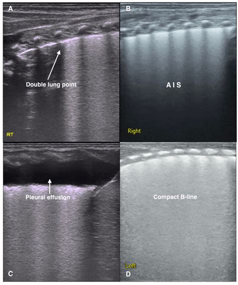 Protocol And Guidelines For Point Of Care Lung Ultrasound In Diagnosing