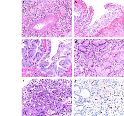 A The Gallbladder Specimen Shows Fibrinoid Necrosis Of Medium Sized