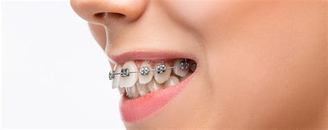 Overbite Overjet Causes Symptoms And How Is It Treated « Smile Team Orthodontics Blog