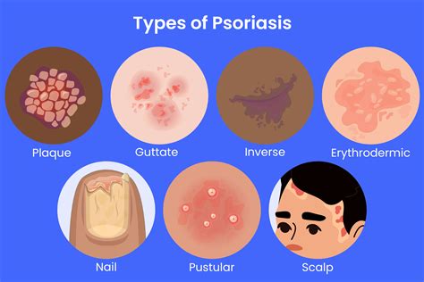 Discoid Psoriasis Pictures Types Of Psoriasis Psoriasis Pictures