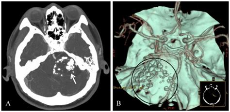 Preoperative Cta Images Showing Calcification And The Intracranial