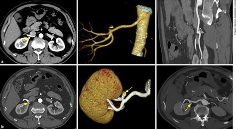 Table 1 From Robot Assisted Laparoscopic Retroperitoneal Renal Artery