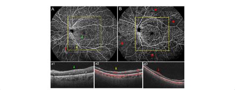 A Representative 24 Mm × 20 Mm Octa Image Of One Eye With Pdr Download Scientific Diagram