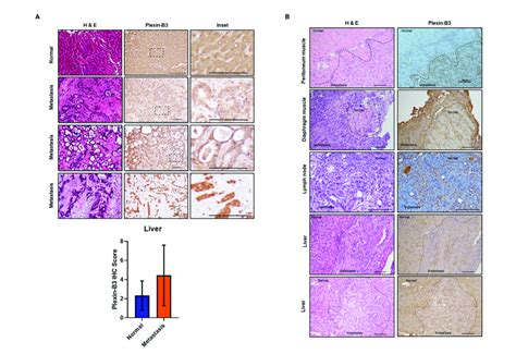 Pathological Expression Of Plexin B3 In The Metastatic Sites Of Pc A