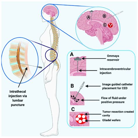 Various Invasive Technologies To Increase Drug Delivery To The Brain By Download Scientific