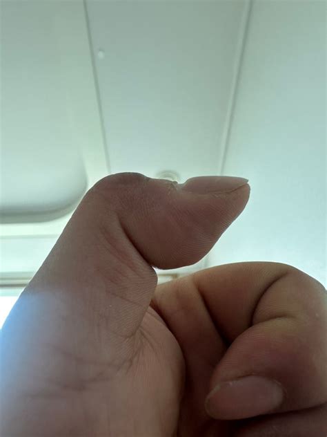 왼쪽 엄지손톱 파임 지식in