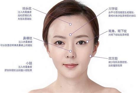 玻尿酸注射除皱的效果能维持多久呢有哪些优点