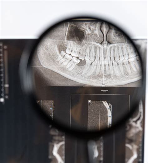 Temporomandibular Joint Disorder Tmj Treatment Dedicated Sleep 888