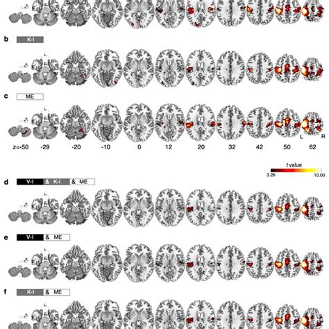 Spatial Distribution Of The Left Primary Motor Cortex Based Functional
