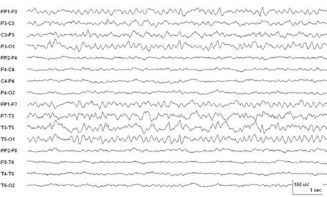 Acns Critical Care Eeg Terminology Training Module 2021 Flashcards Quizlet