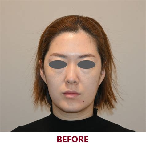 피부 레이져 기미·색소·잡티 샤인봄 클리닉