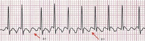 Scielo Brasil Neonatal Atrial Flutter After Insertion Of An