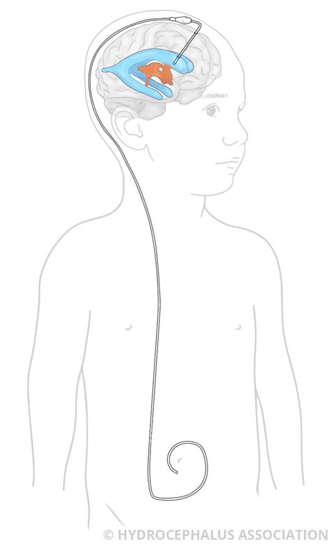 4 Types Of Shunt Systems For Hydrocephalus What To Know